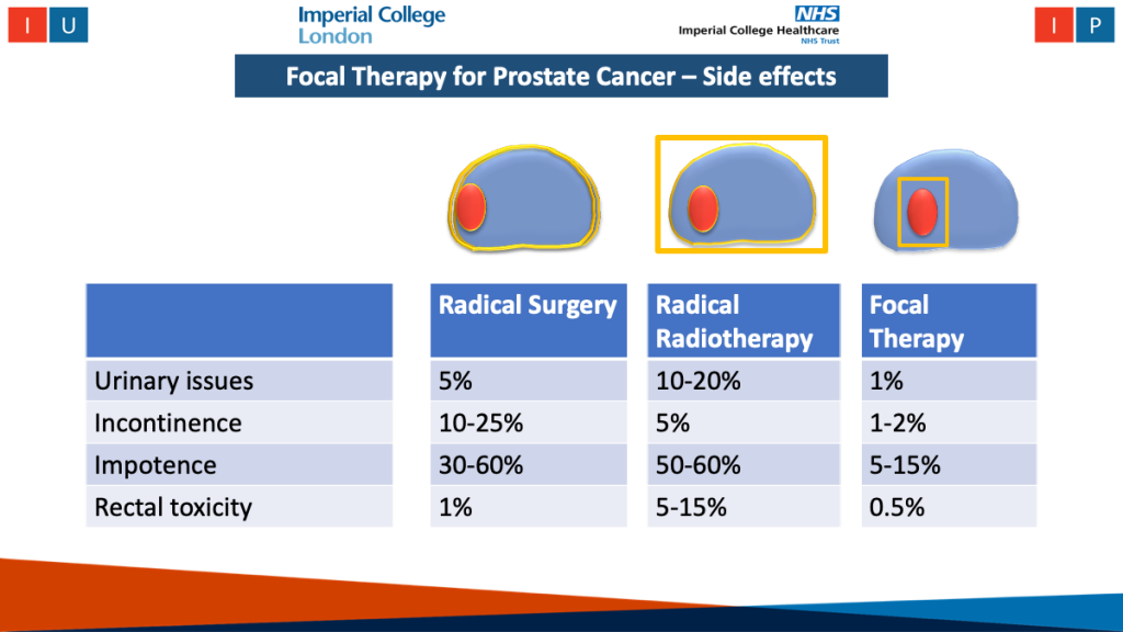 HIFU for Prostate Cancer Treatment | Prof. Hashim Ahmed